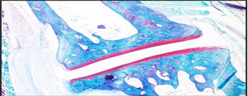 Biocompatible Drug System Solution For Rheumatoid Arthritis - Indian Flash